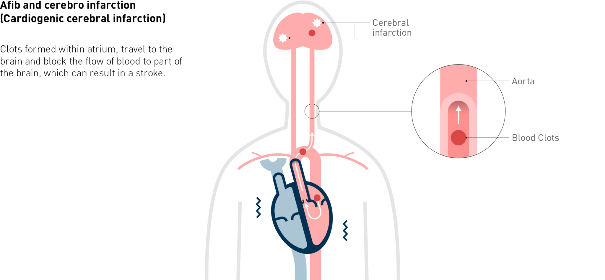 ECG Informative Landing Page | Omron Healthcare